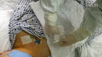 传统中心静脉插管治疗端的管理