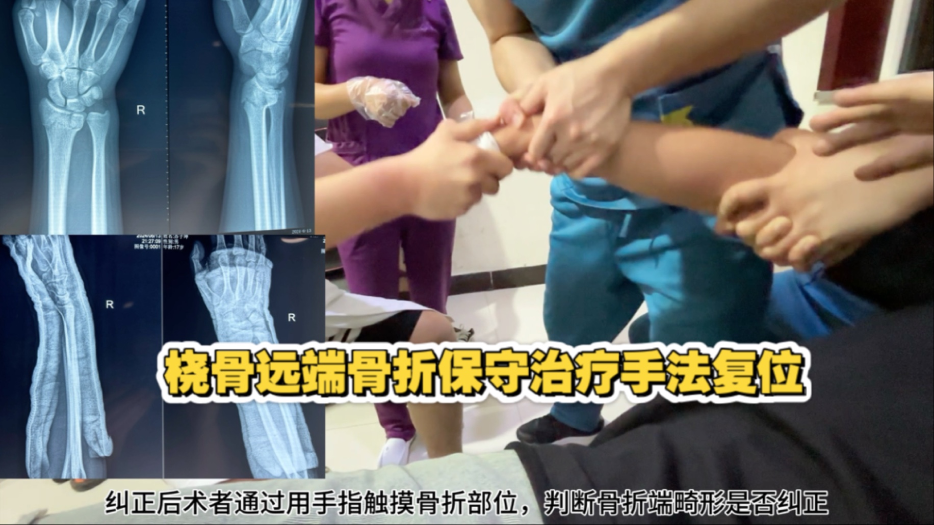 桡骨远端骨折手法复位视频