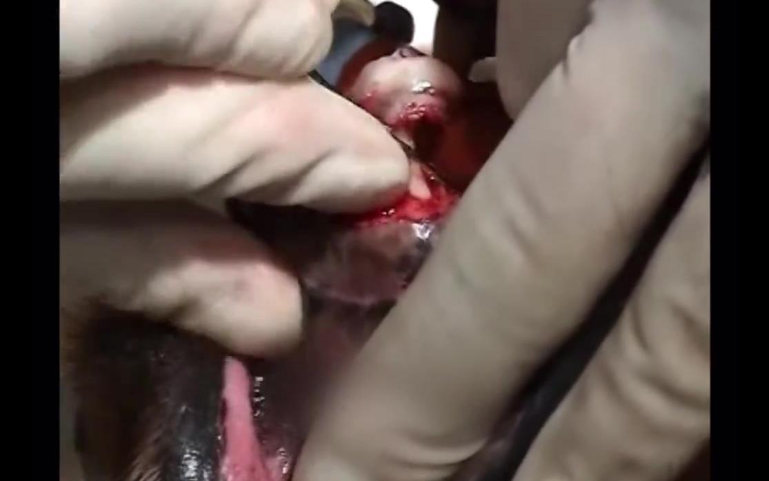 犬牙龈增生切除手术视频