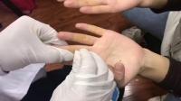四缝放血,健脾胃,治疗小儿积食