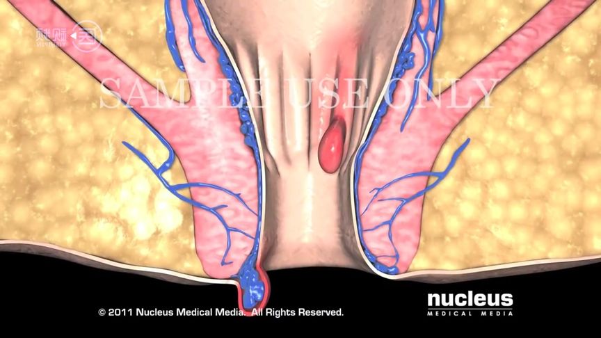 痔疮怎么才能快速治好呢?原来痔疮手术是这么做的!