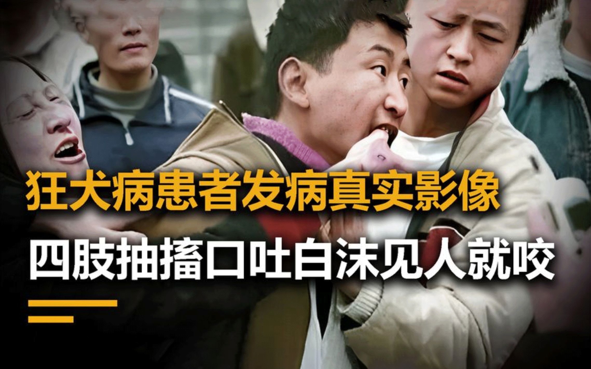 狂犬病患者发病真实影像,全身溃烂口吐白沫,宛如疯狗见人就咬