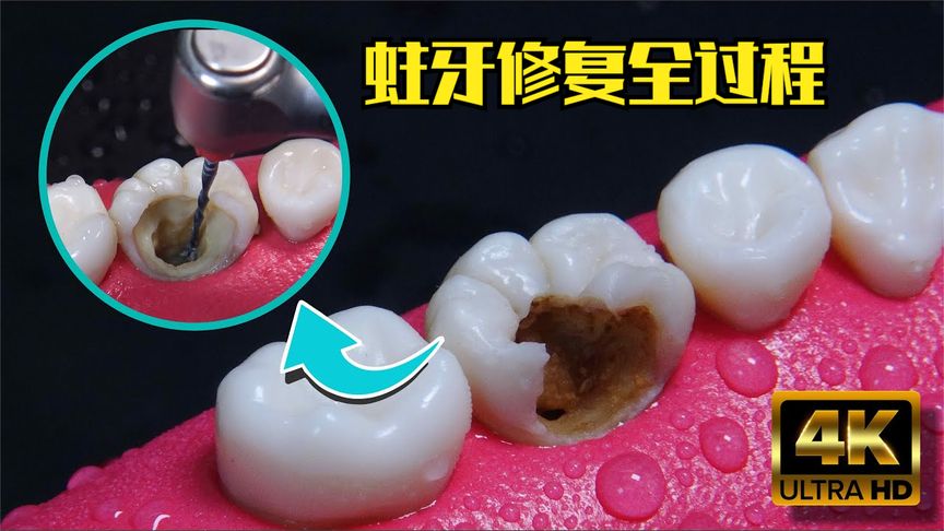 如何修补蛀牙?根管治疗全过程,牙齿重建,看完超解压!