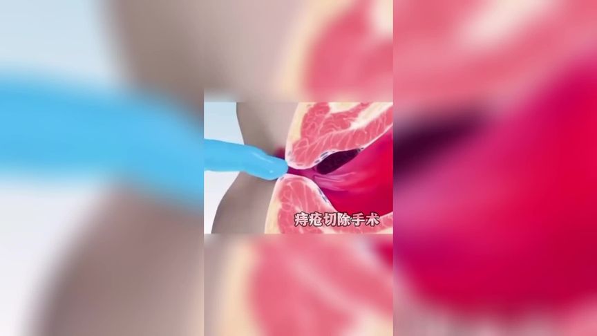 医学科普:痔疮切除手术