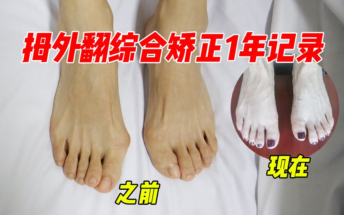 【苏敬达】羽毛球运动员拇外翻综合矫正,1年恢复过程大揭秘