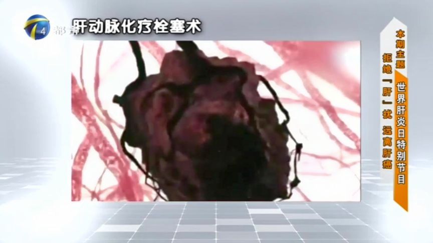 肝癌如何治疗?这段视频带你了解肝动脉化疗栓塞术!|健康直播间