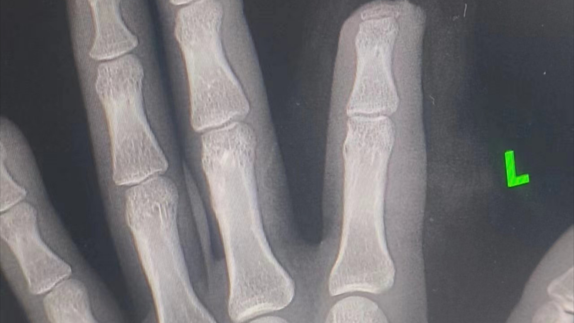 (公益义肢)(公益义肢)知象光电赞助的便携扫描仪助力云南老哥重建信心