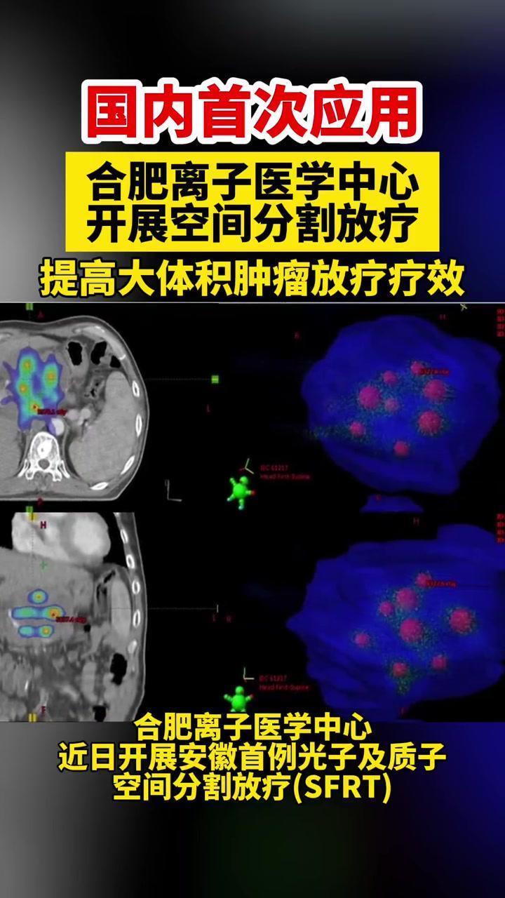 国内首次应用!合肥离子医学中心开展空间分割放疗,提高大体积肿瘤...