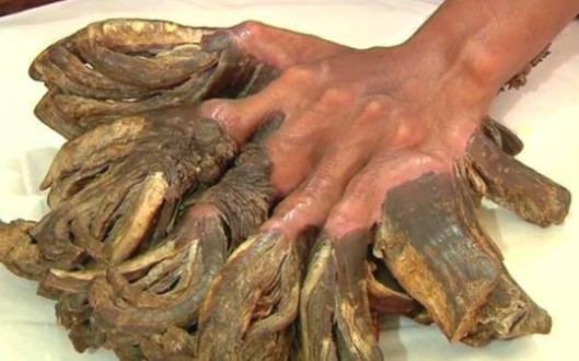 百科探秘—附身的珊瑚,罕见病「树人症」的治疗历程