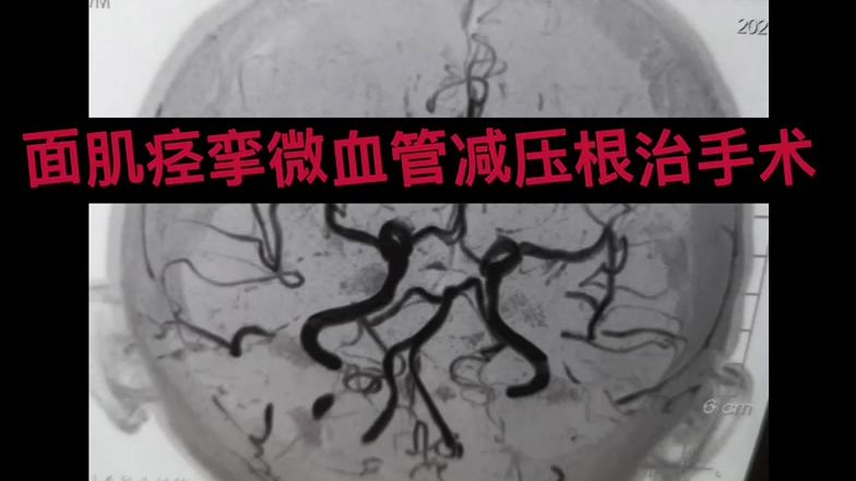 #医学科普 #面肌痉挛微血管减压 根治手术