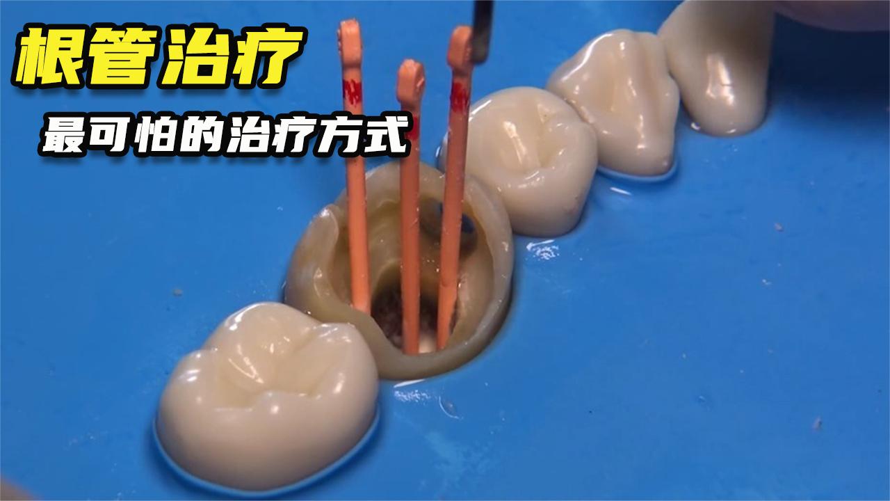 根管治疗到底疼不疼?看完根管治疗全过程告诉你答案