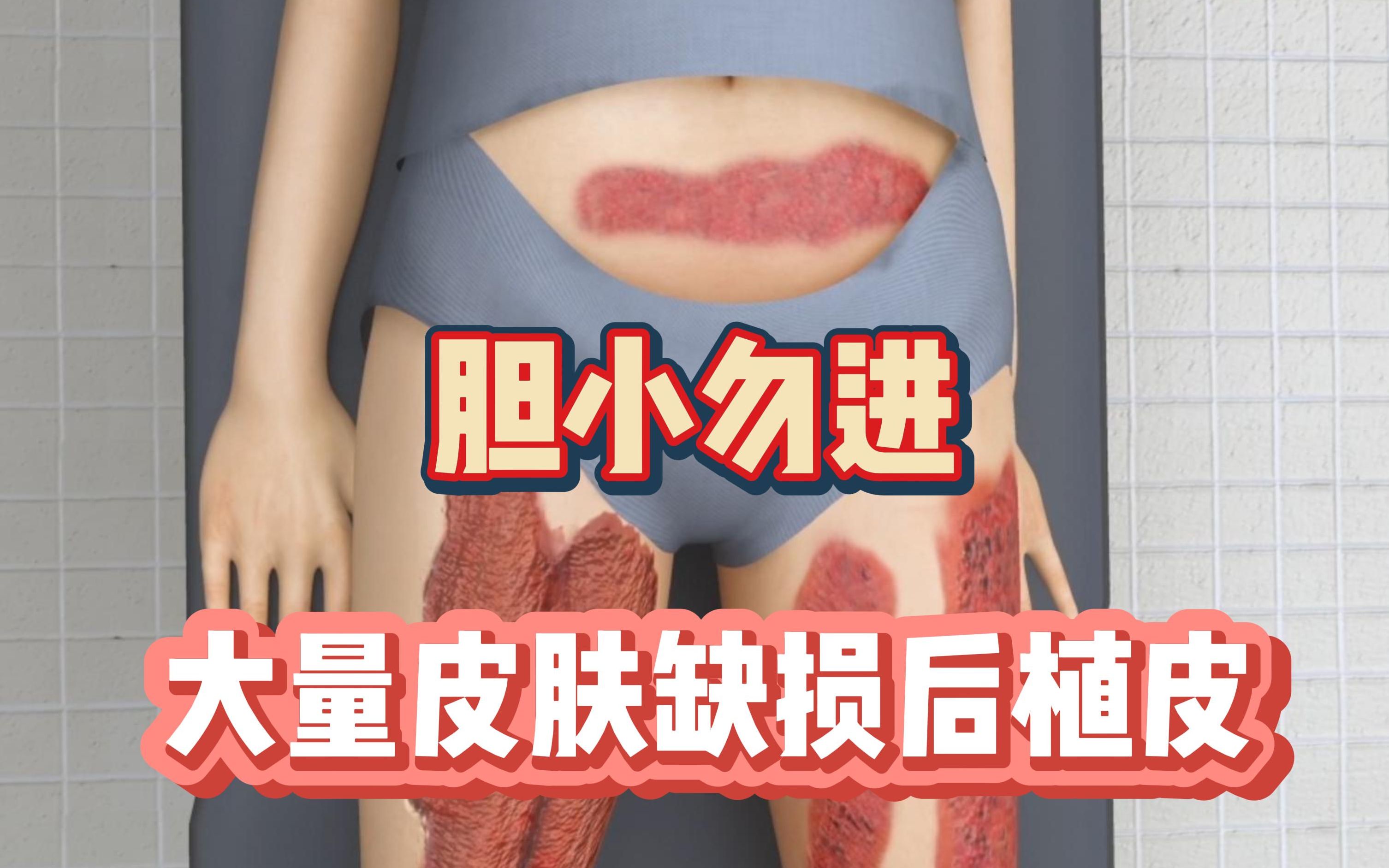 胆小勿进|取皮植皮过程|3D动画|最伟大的作品