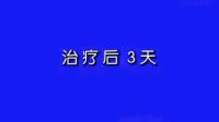 得了亨廷顿舞蹈病后遗症怎么办?