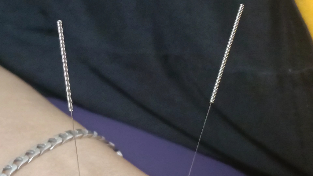 穴位演示:针刺内关穴,神门穴得气后针体自摇,是针灸中得气表现之一