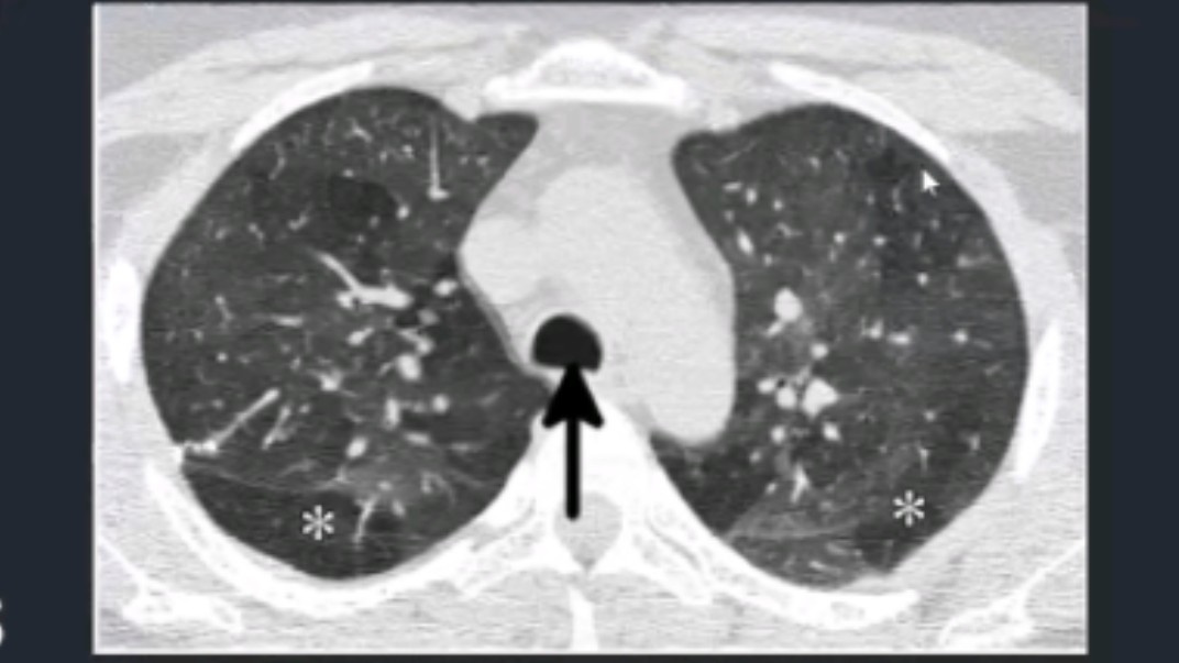 胸部CT马赛克征