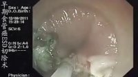 早期食管癌内镜黏膜下剥离术