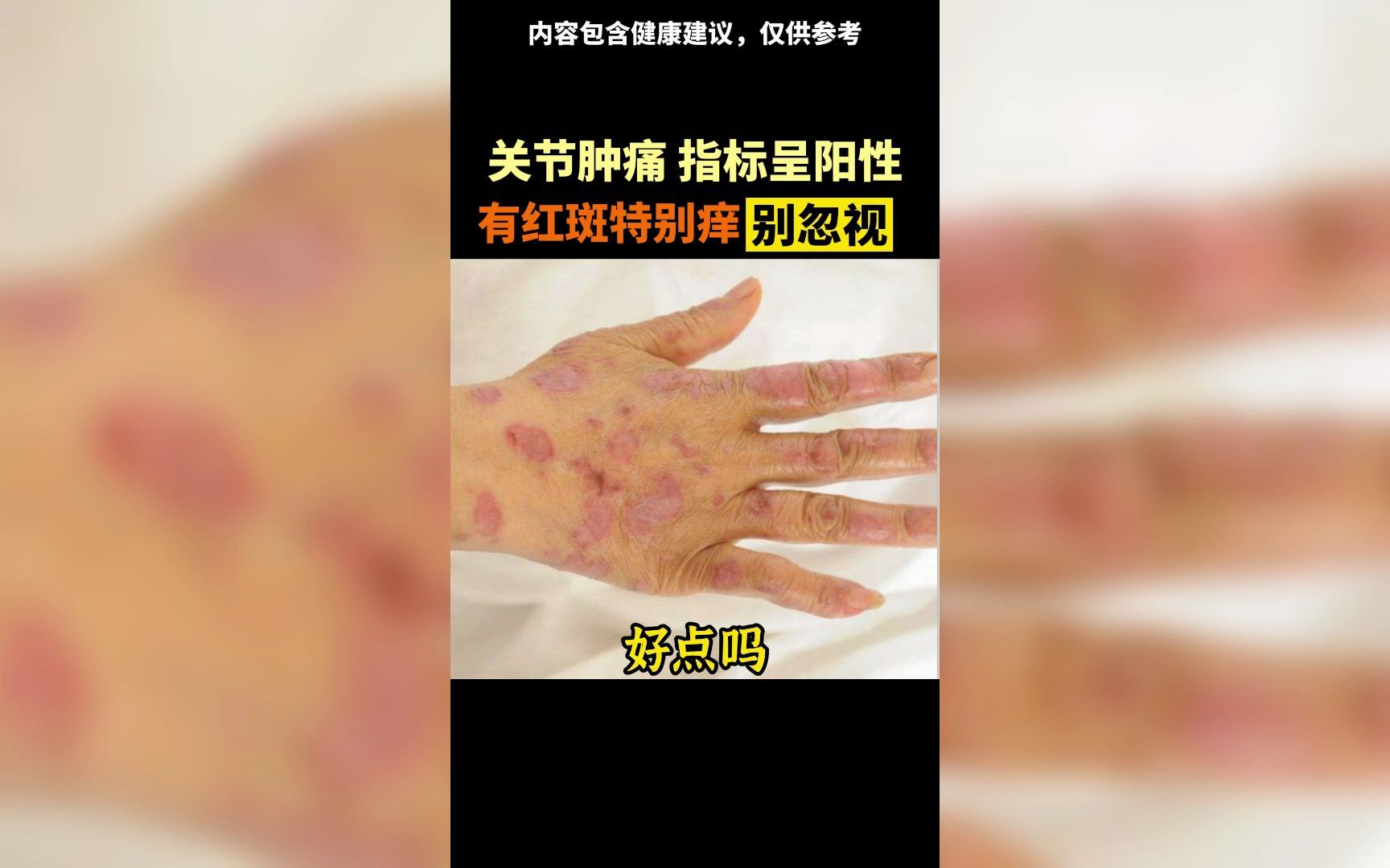 结缔组织病这项指标呈阳性,可别忽视了