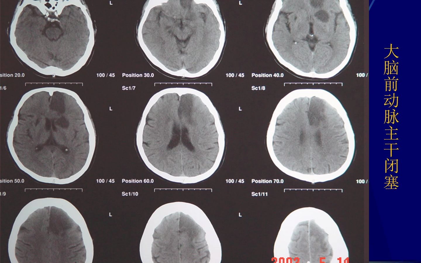 脑血管解剖及全脑血管造影术PPT