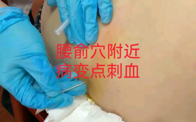 腰俞穴附近病变点点刺实操