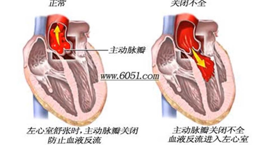 主动脉瓣置换,升主动脉置换术护理查房PPT
