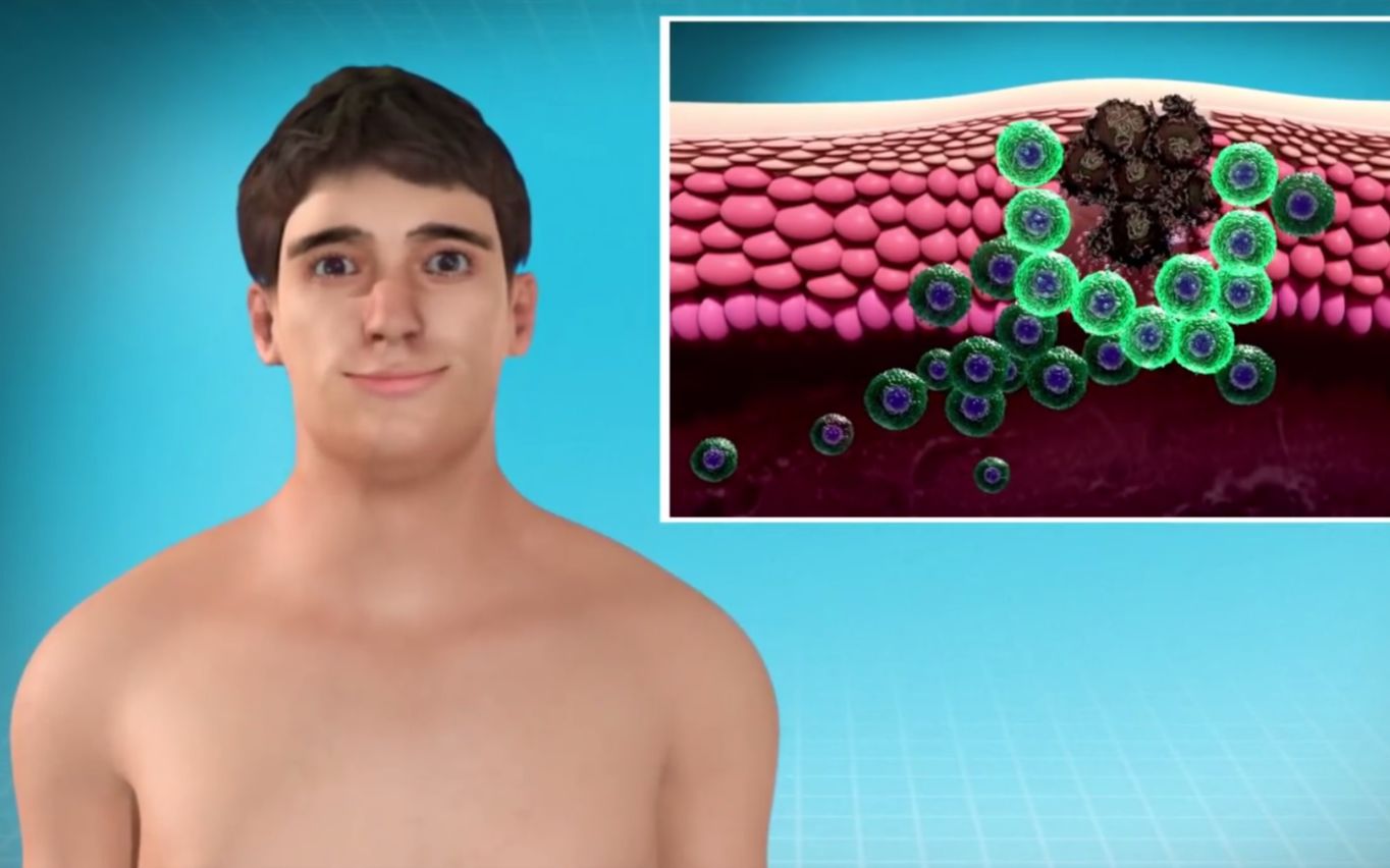 免疫治疗---攻克癌症的希望中英文字幕版