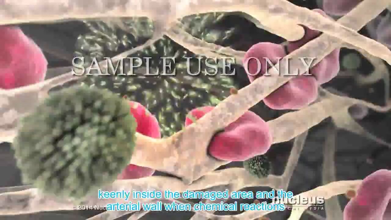 医学动画:动脉硬化如何导致冠心病