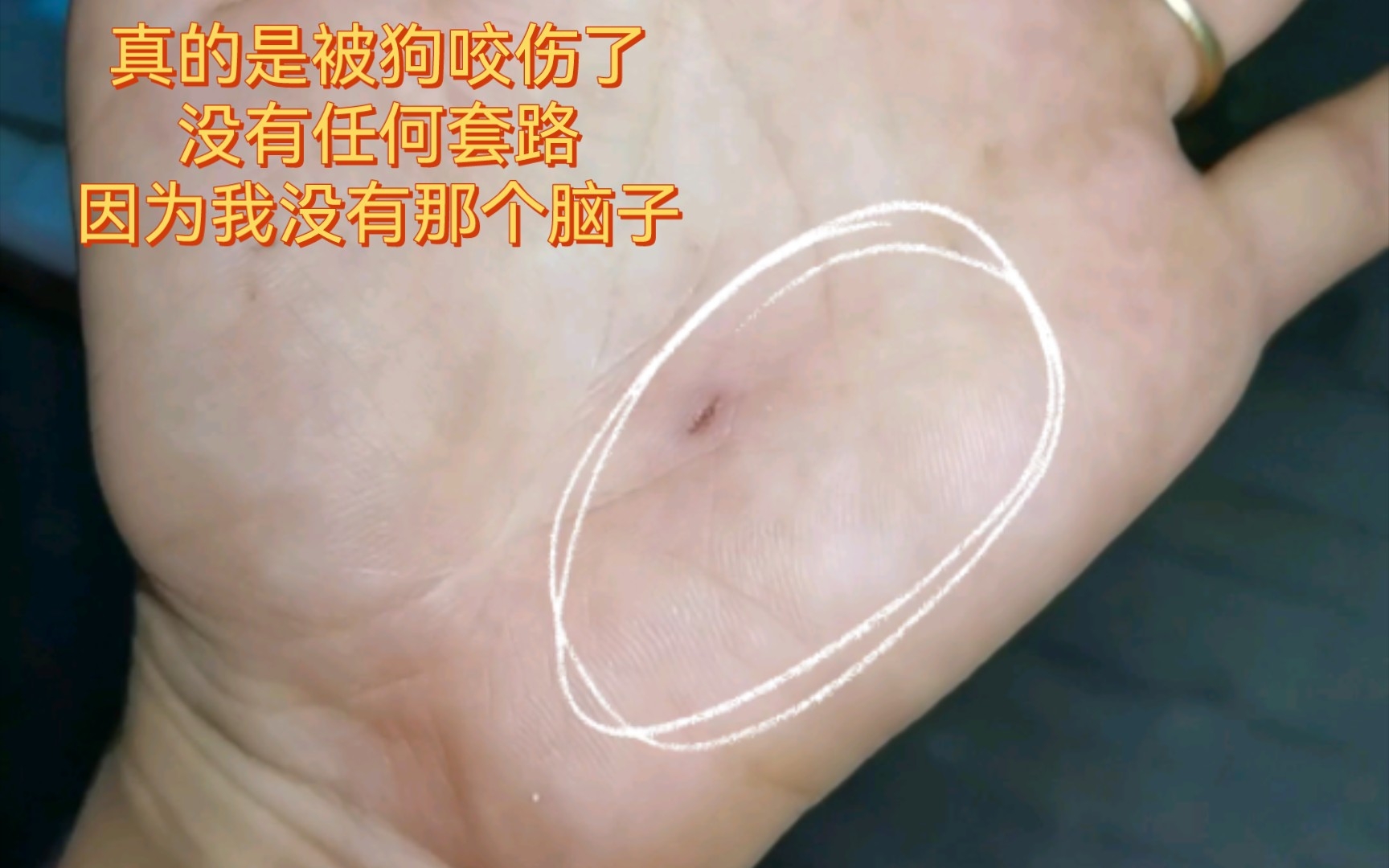 之前发布了我因为劝架被狗咬的视频,好多人觉得不是真的,我澄清一下...