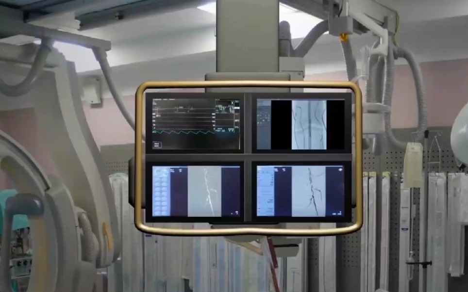 动画演示血栓抽吸导管