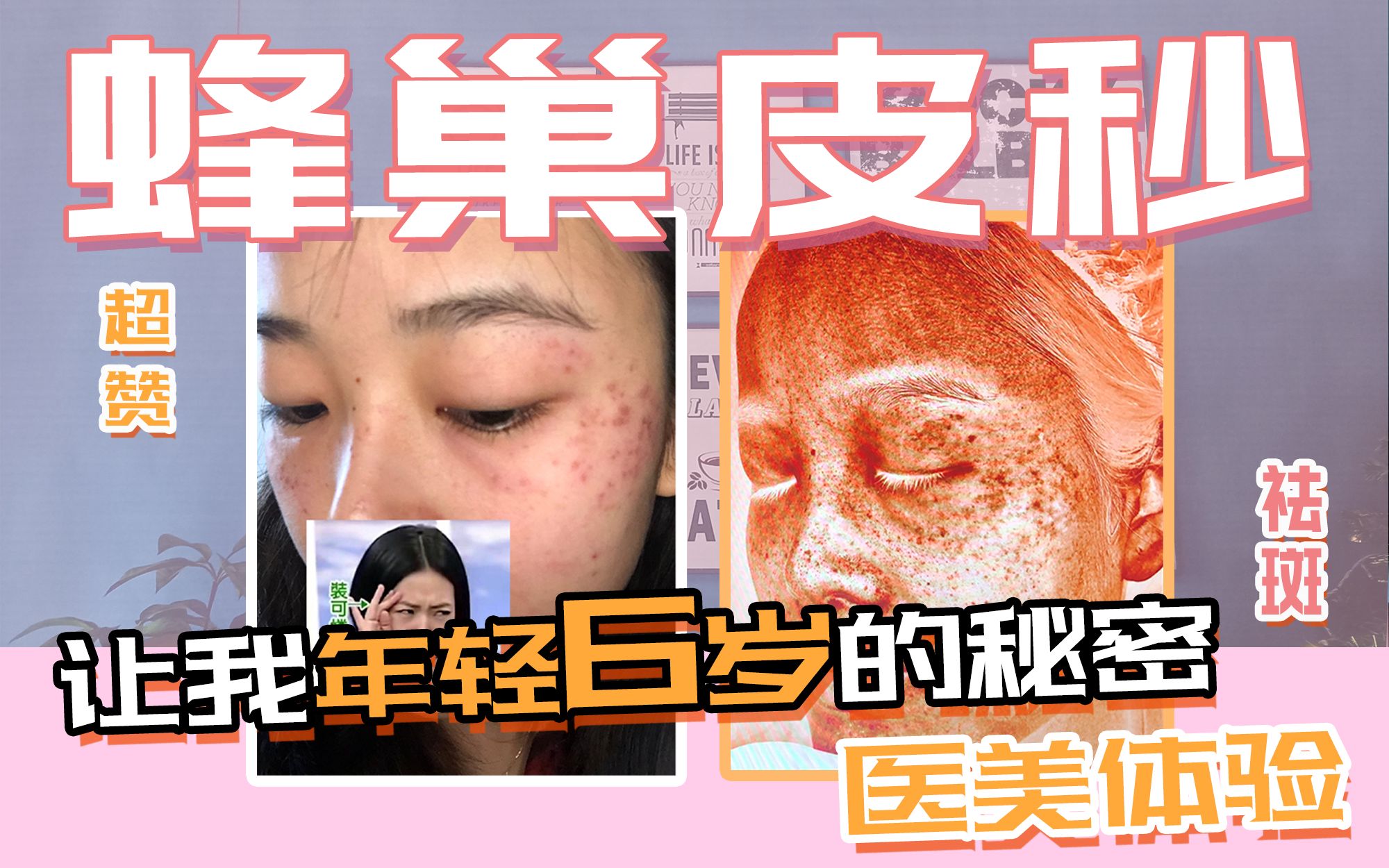 【辣娇】医美|拯救雀斑瑕疵脸!上万元的蜂巢皮秒是智商税吗?