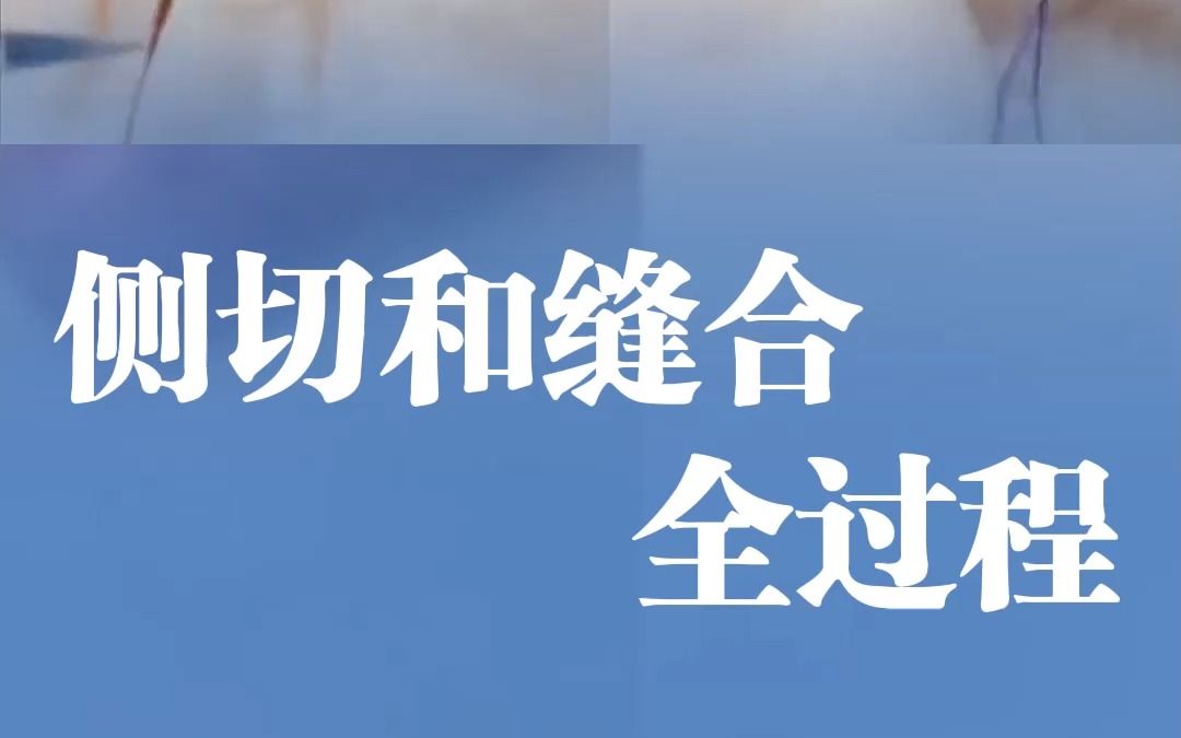 侧切和缝合全过程