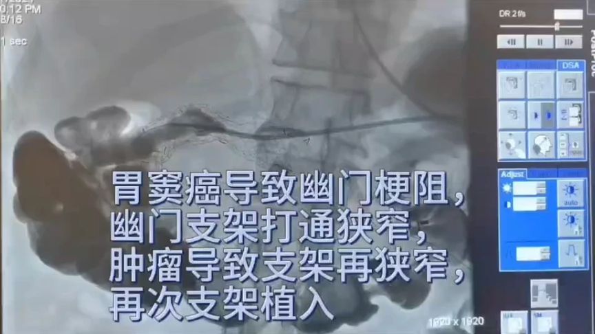 幽门支架的释放如同艰难的行军,支架再狭窄二次放支架更是难上难