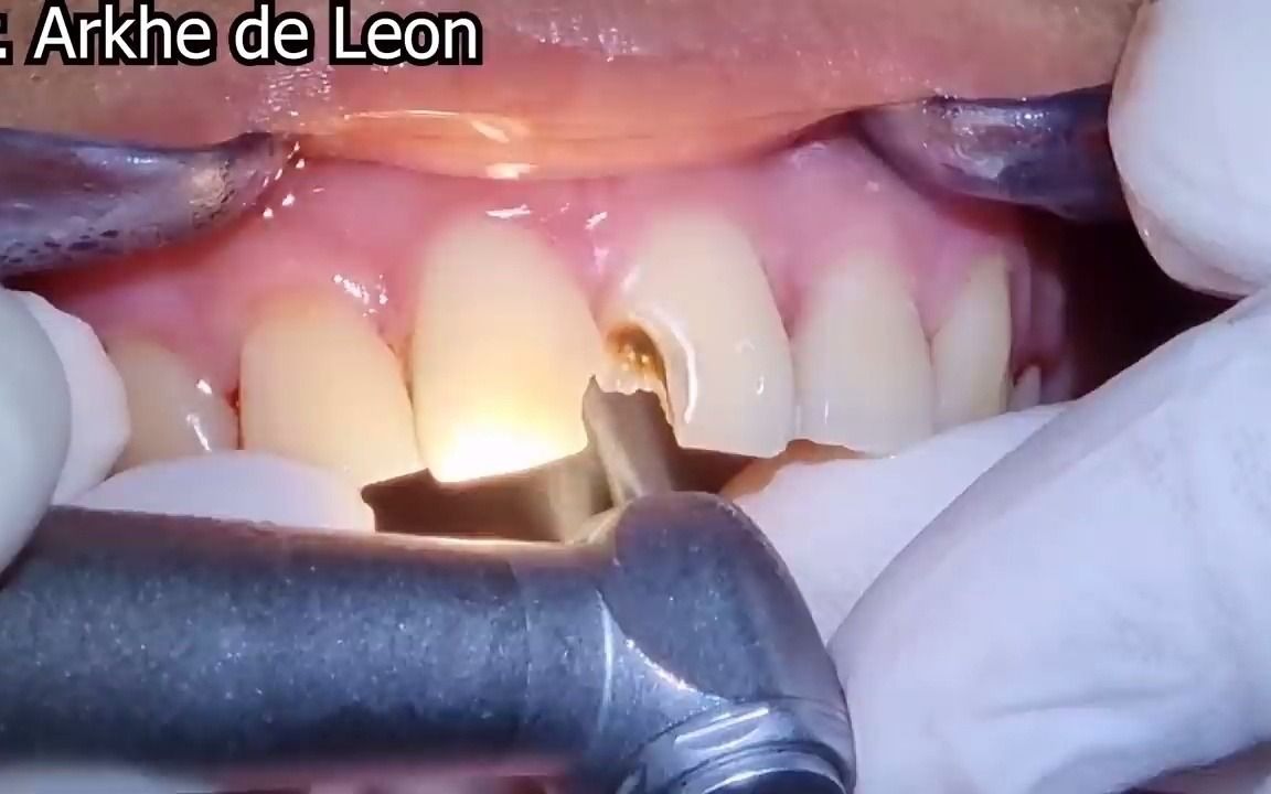 真实记录补牙全过程,看完你还怕补牙吗?