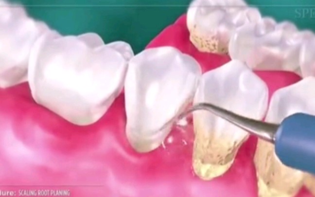 3D演示洗牙+龈下刮治,一起来感受下