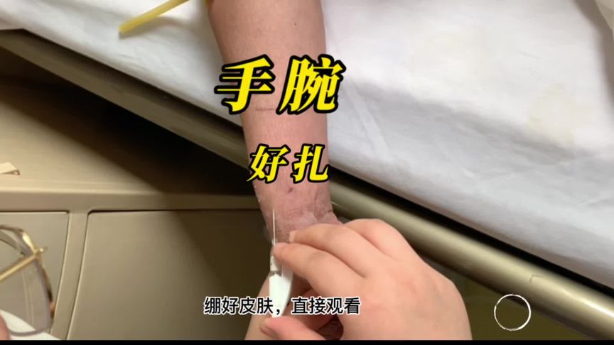 留置针穿刺日常分享…手腕,好扎#护士 #留置针