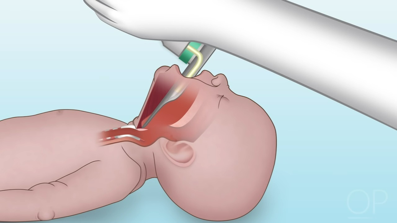 新生儿气管插管(1080P)(中文字幕可手动开启)