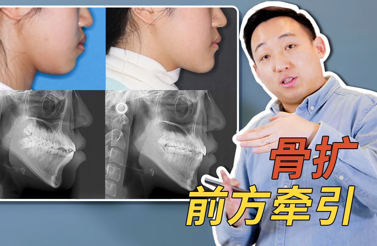 骨性扩弓+前方牵引装置,解决骨性三类反合病例