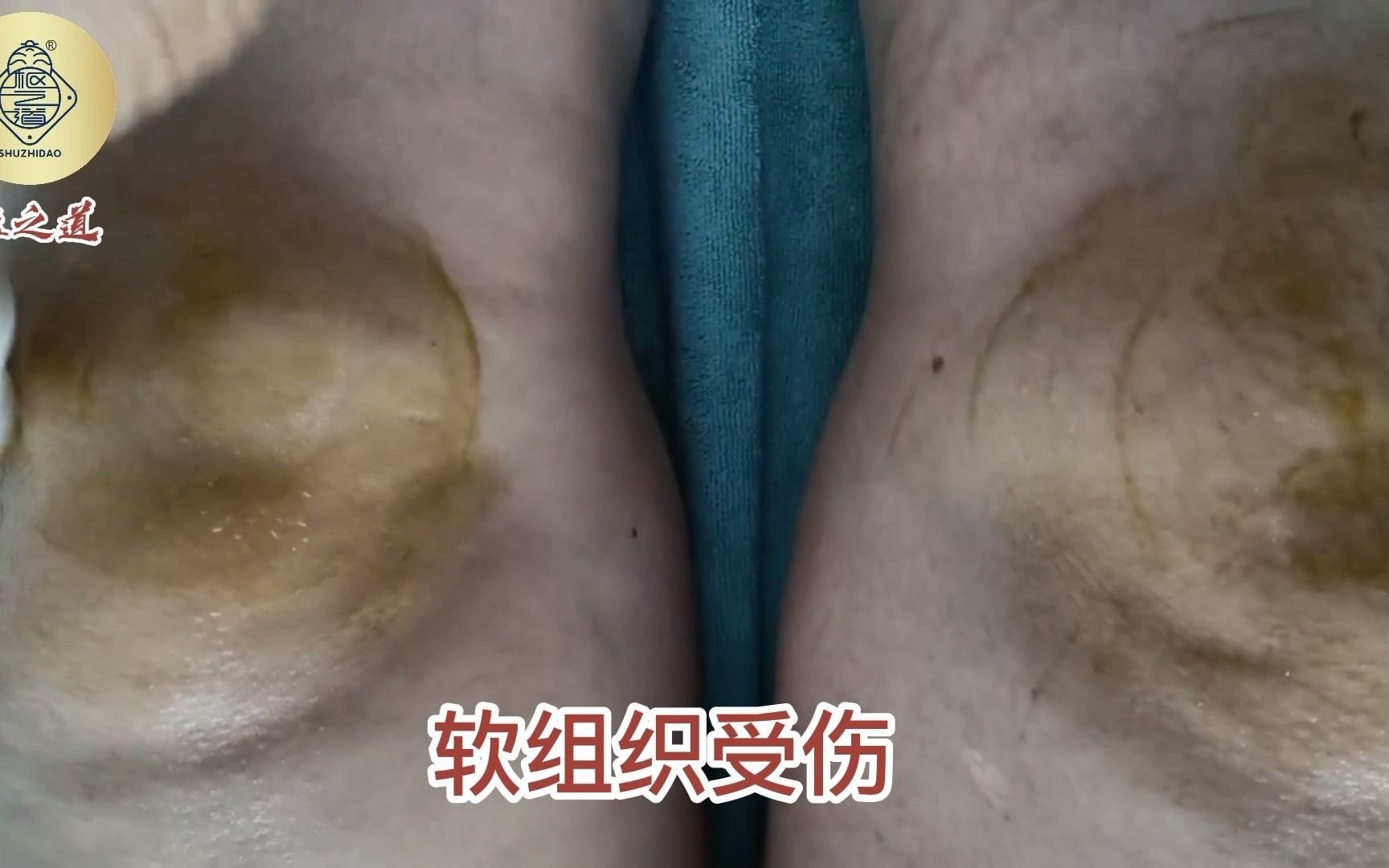 软组织损伤,膝盖疼的厉害,抹上小分子活络膜好多了!