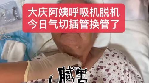 呼吸机脱机气切换管成功