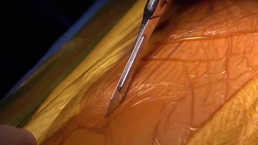 桡动脉获取技术