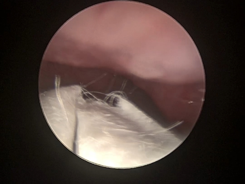 鼻出血该怎么治?鼻腔中的电焊工:电凝止血术!