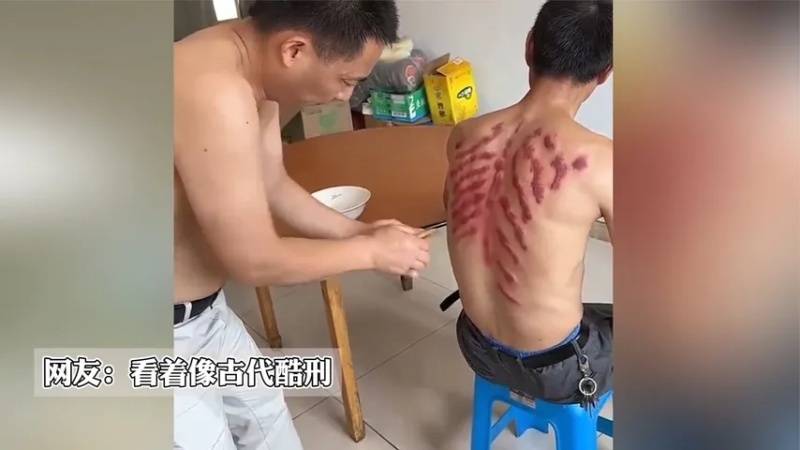 男子用夹子帮客人刮痧,整个背部出现一道道血痕