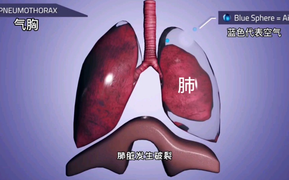 肺破了如何把气体排出来,胸腔闭式引流术原理,3D演示。