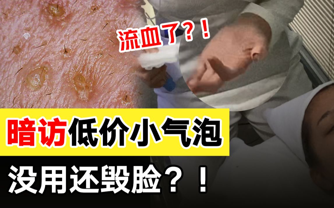 去黑头的王?暗访4.9元低价小气泡,美容师手指流血操作,吓傻了?