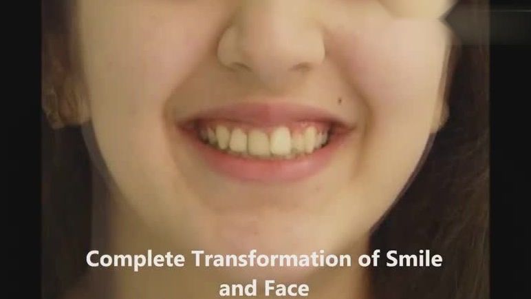 正畸医生带你来了解牙齿矫正的全部过程