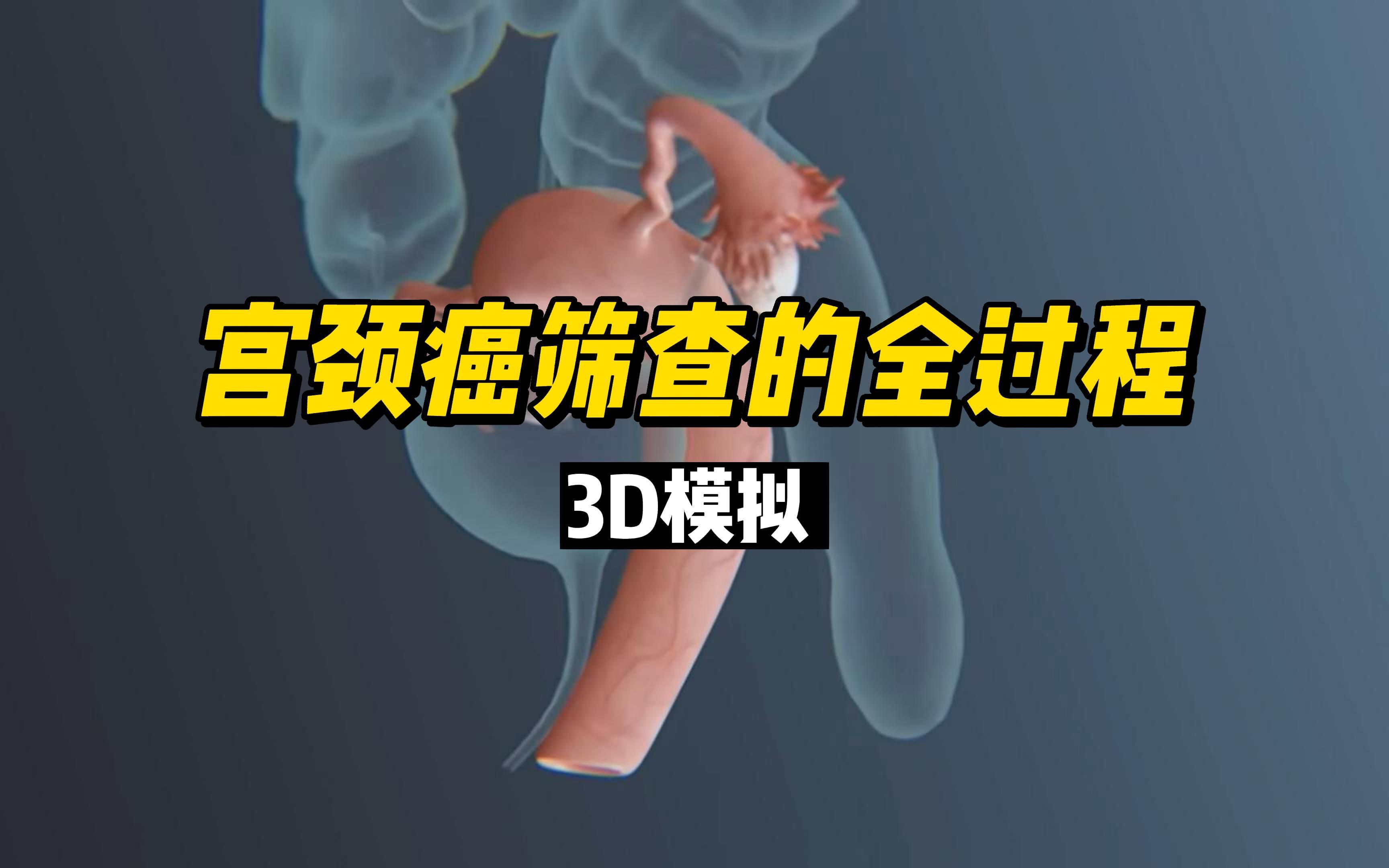 科普视频:宫颈癌筛查的全过程!