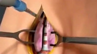 气管切开术,3D医学动画演示全过程,网友:没点胆子还真不适合当医生!