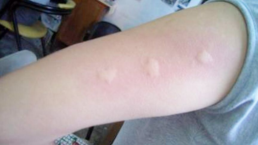 被蚊虫叮咬不要挠,3种快速止痒又杀菌的土方法,安全无副作用!