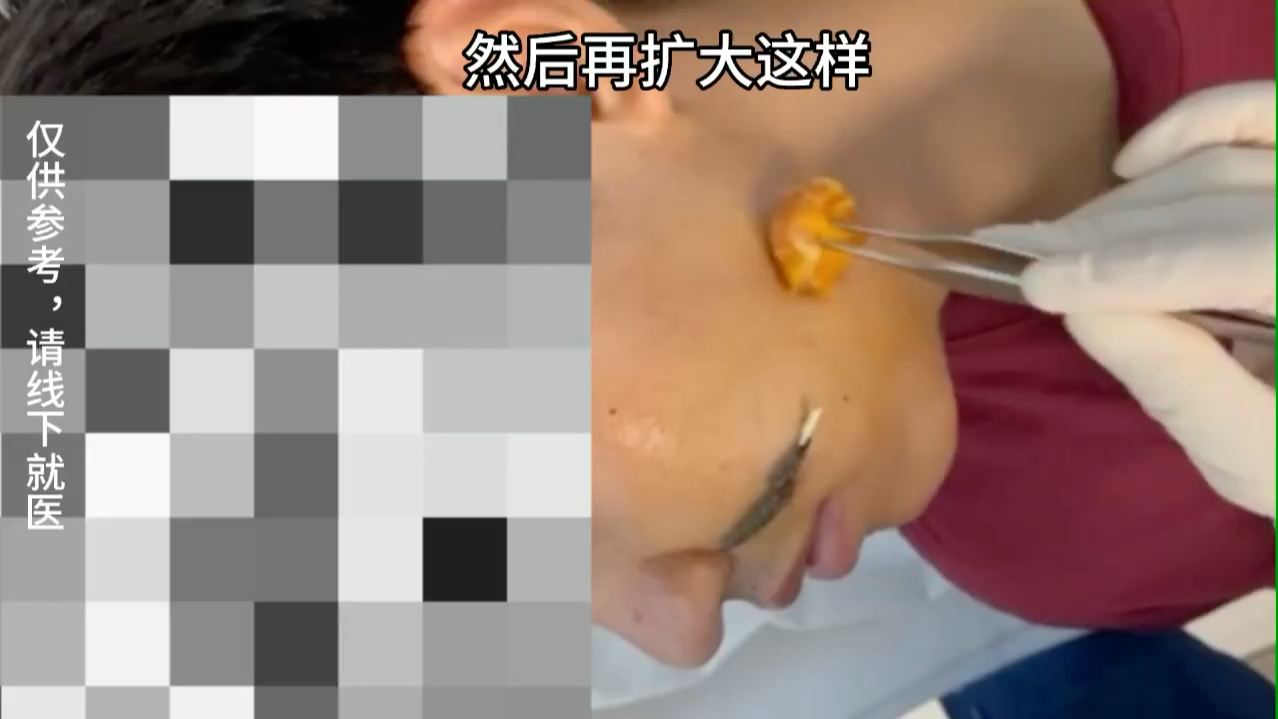 拆线之前,如何在家换药,伤口怎么消毒。拿什么消毒?