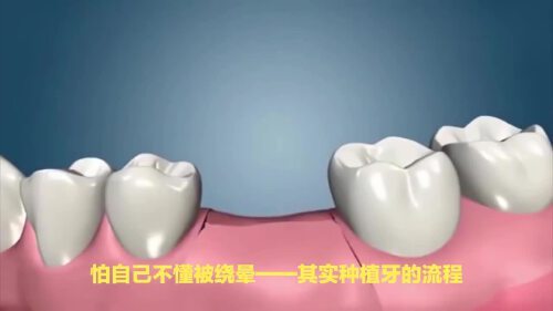 种牙全流程揭秘:从检查到戴冠,手把手教你告别焦虑