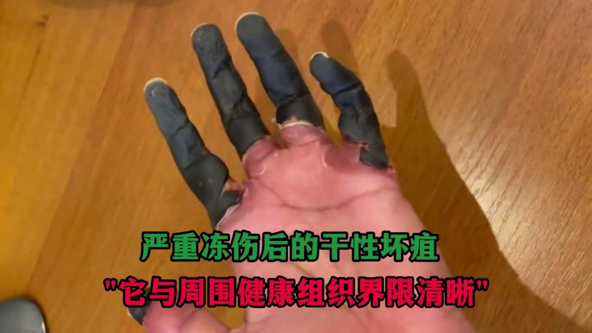 【疾病】严重冻伤后的干性坏疽